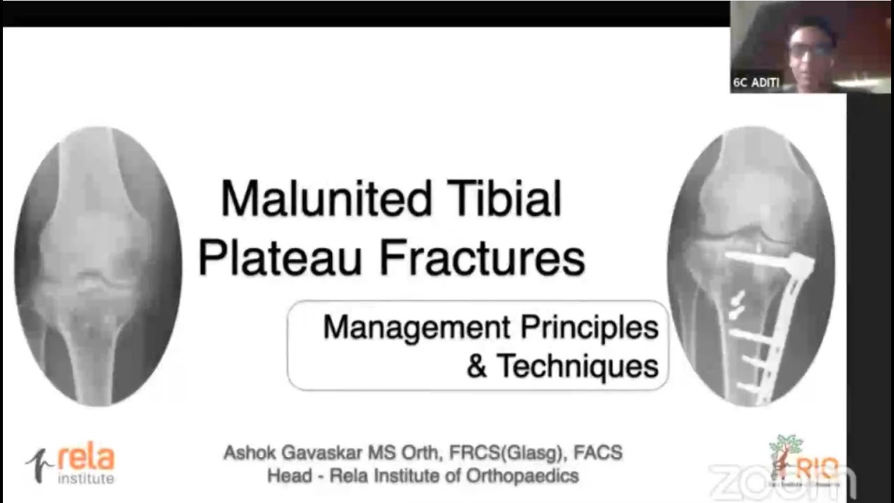 Dr Ashok Gavaskar - Malunited Tibial Plateau Fractures - YouTube