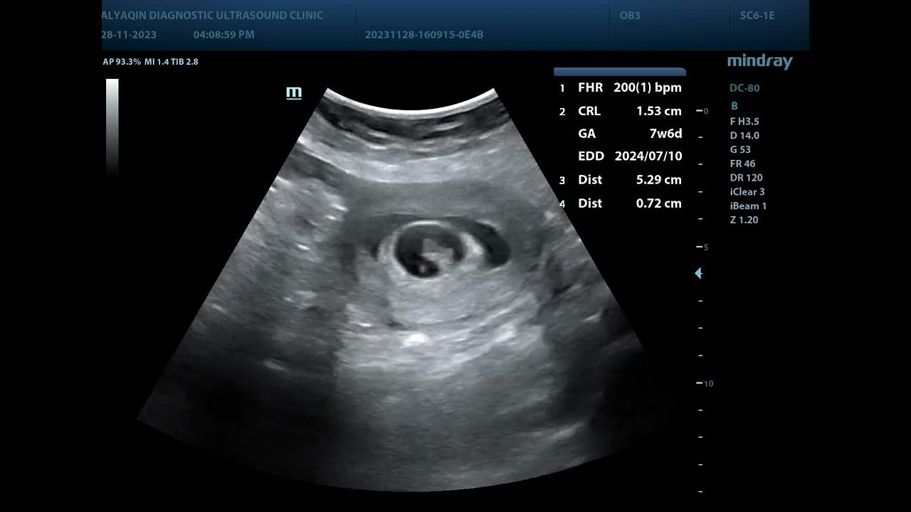 A crescent-shaped subchorionic hematoma ultrasound #shorts - YouTube