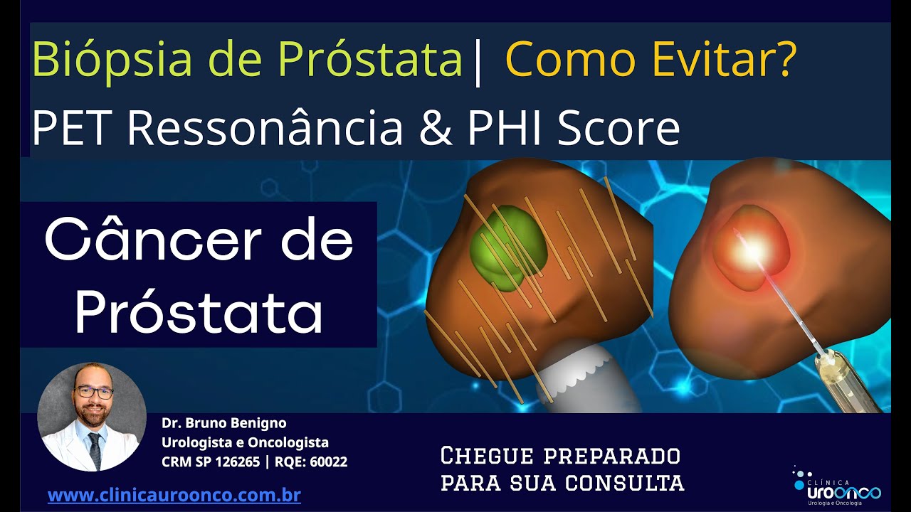 Como evitar biópsia de próstata desnecessária? Conheça o PET ...