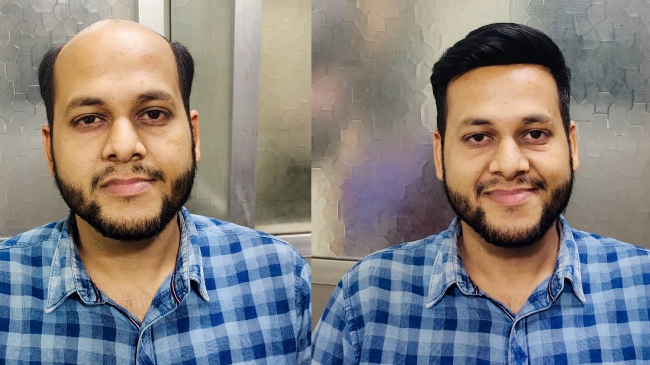 Hair Patch Restoration: Transforming Baldness into Natural Hair ...