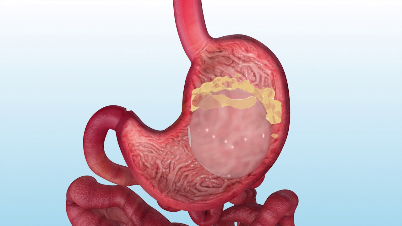 ORBERA Patient Animation Placement & Removal - YouTube