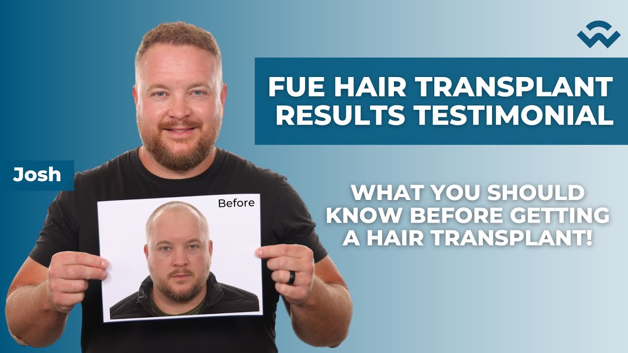 FUE Hair Transplant Results - What you should know before getting a ...
