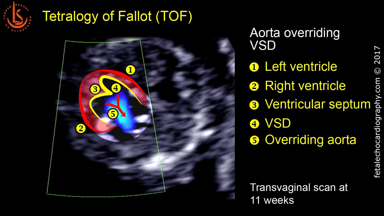 Siêu âm tim thai sớm 11-13 tuần - Tứ chứng Fallot - Tetralogy of Fallot ...