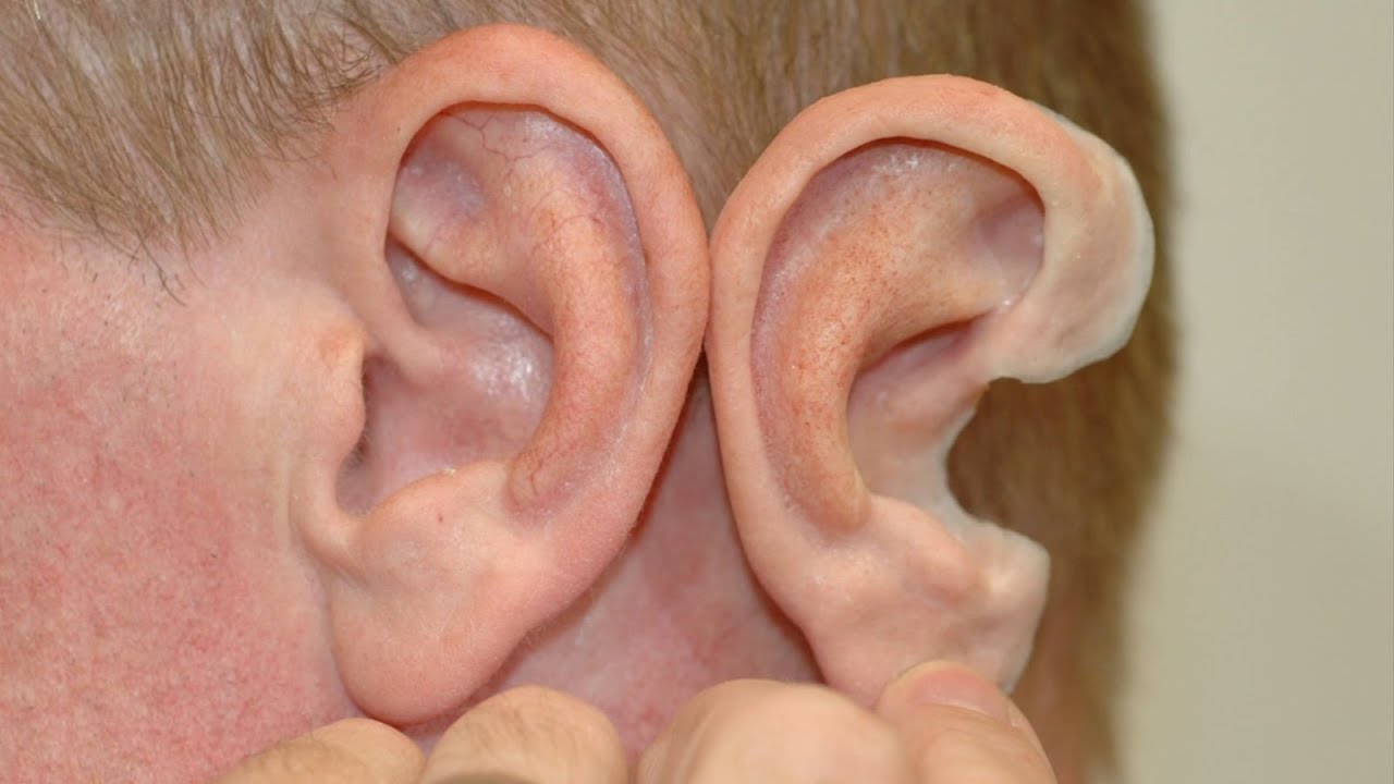 Ear Prosthetics - YouTube