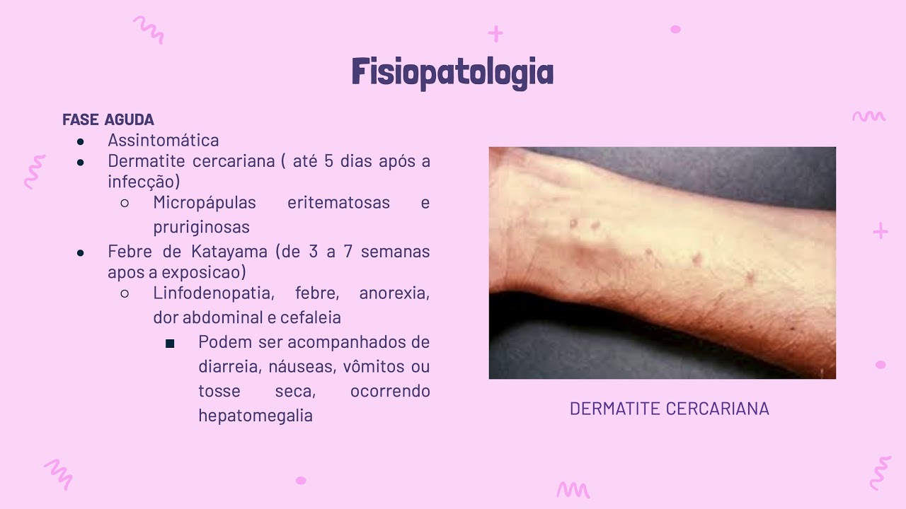 Esquistossomose Mansônica Parasitologia FMJ - YouTube
