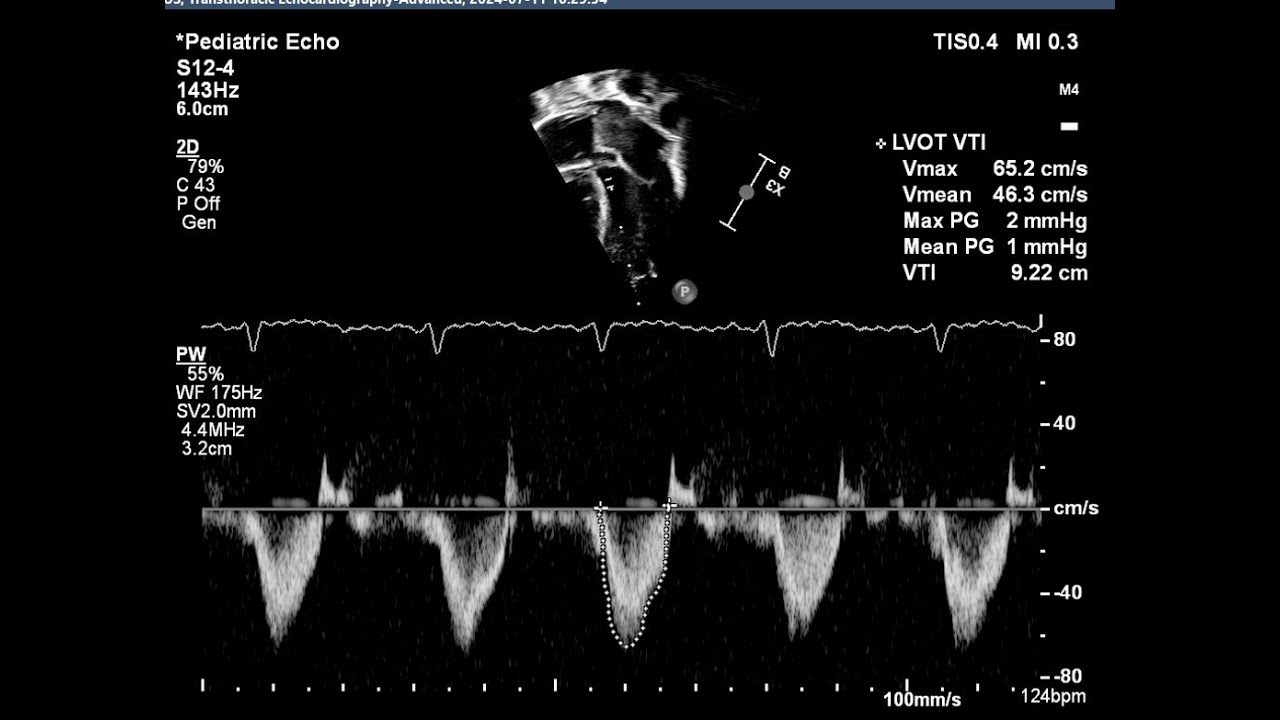 Basic echocardiography(심장 초음파 기본)- cardiac output/stroke volume 측정 ...