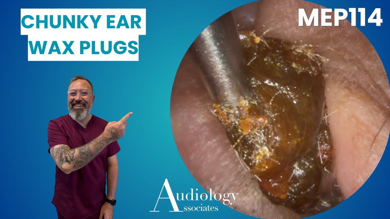 Ear Wax Removal Compilation, Big Plugs & Dry Skin - MEP114 - YouTube