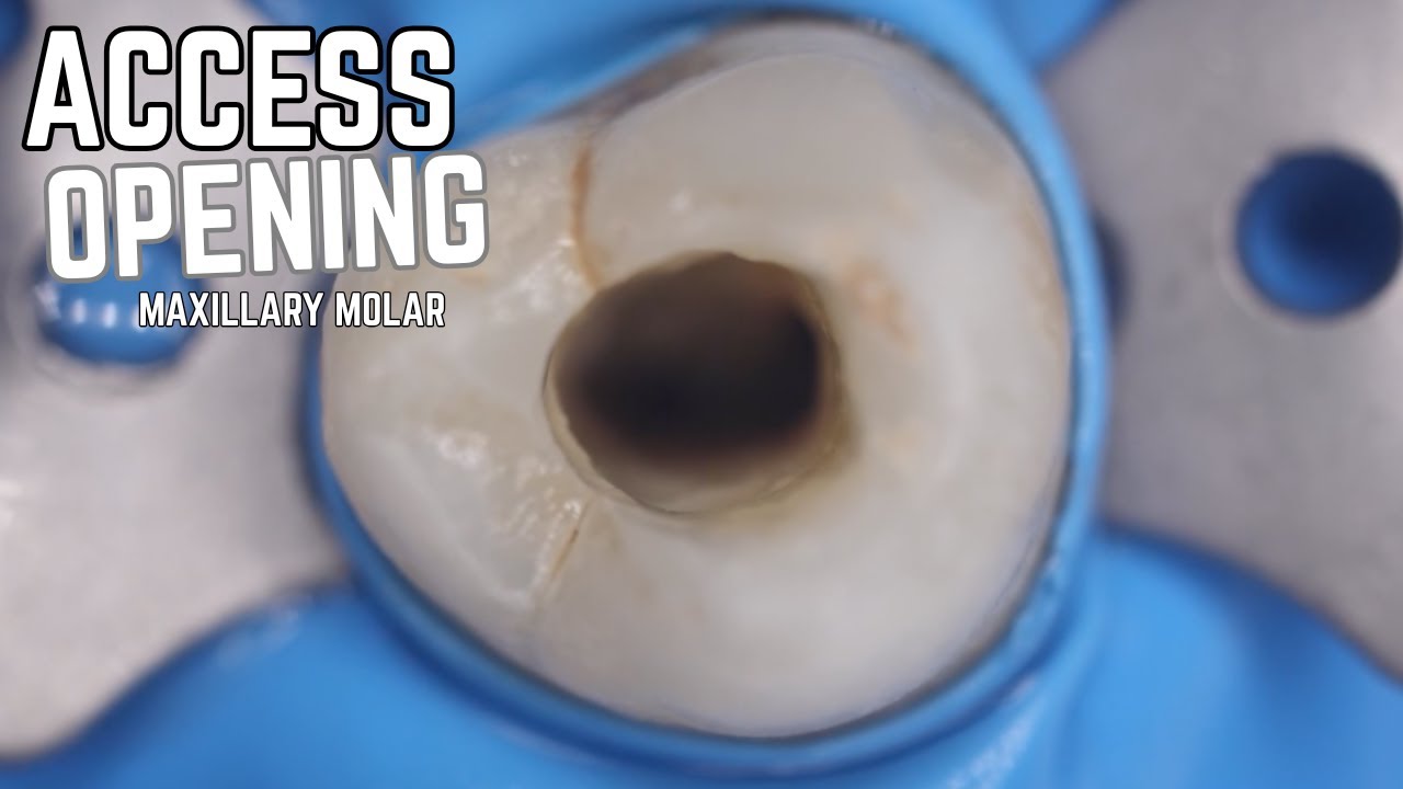 Access Opening in Maxillary Molar ⚪️ Step by Step - YouTube