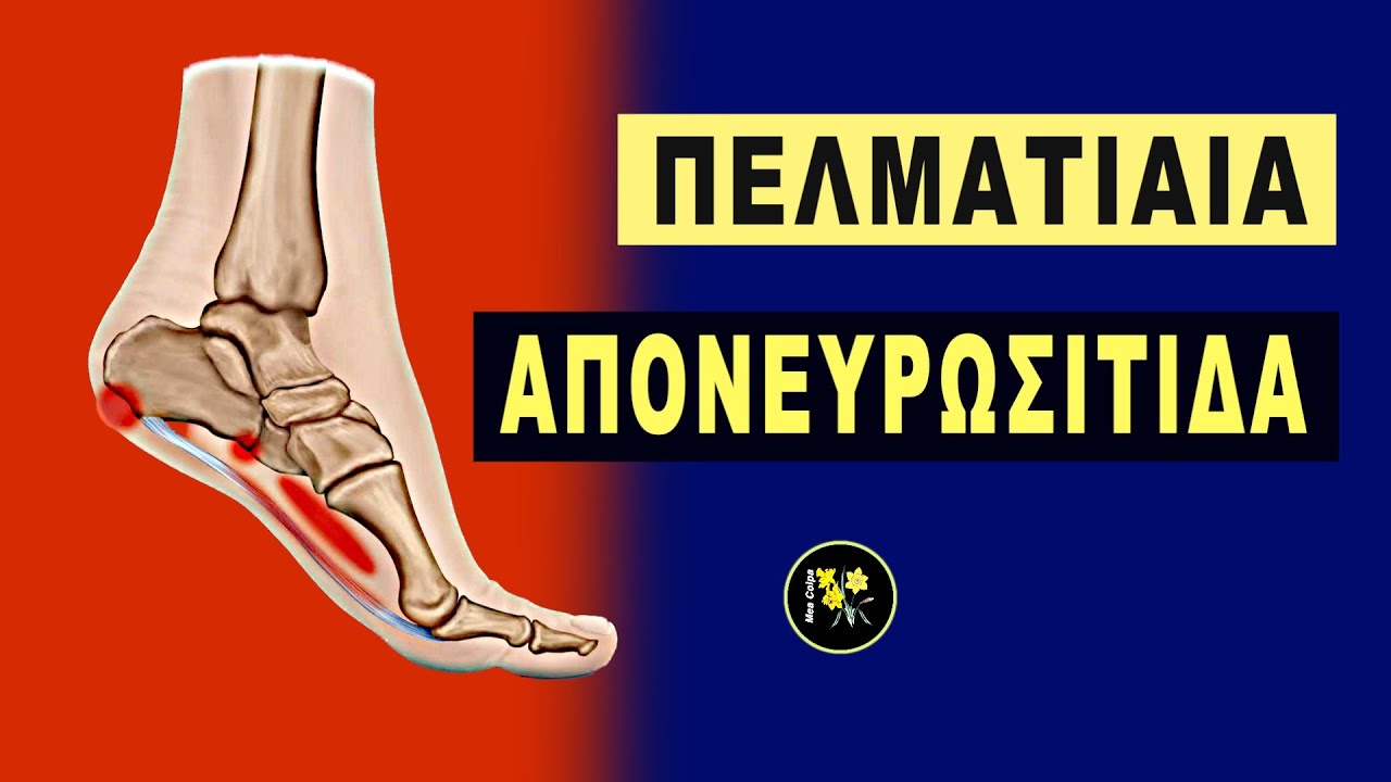 Πελματιαία Απονευρωσίτιδα - Σπιτικές Θεραπείες & Ασκήσεις - YouTube