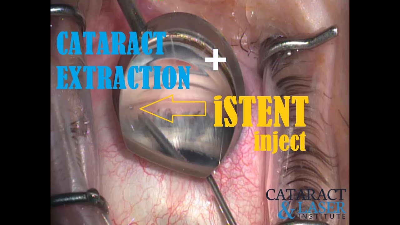 How to iStent: Cataract extraction w/ iStent Inject (MIGS) - YouTube