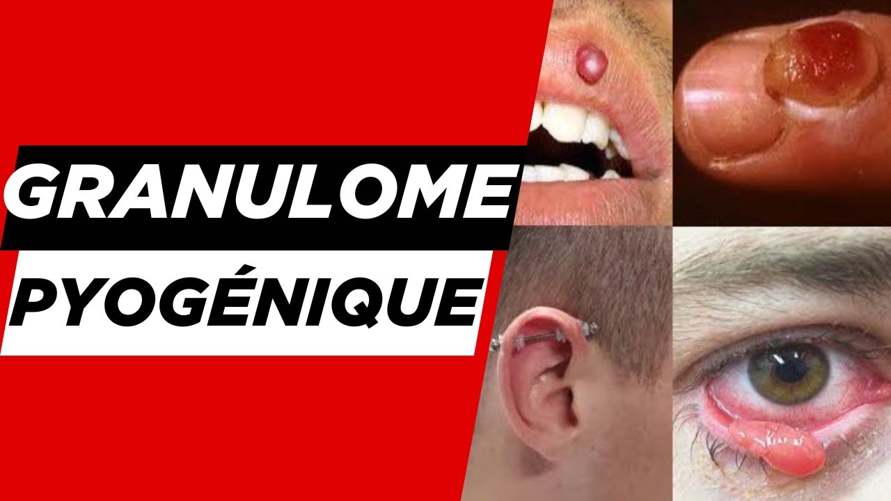 Granulome pyogénique | Causes | Symptômes | Traitement - YouTube