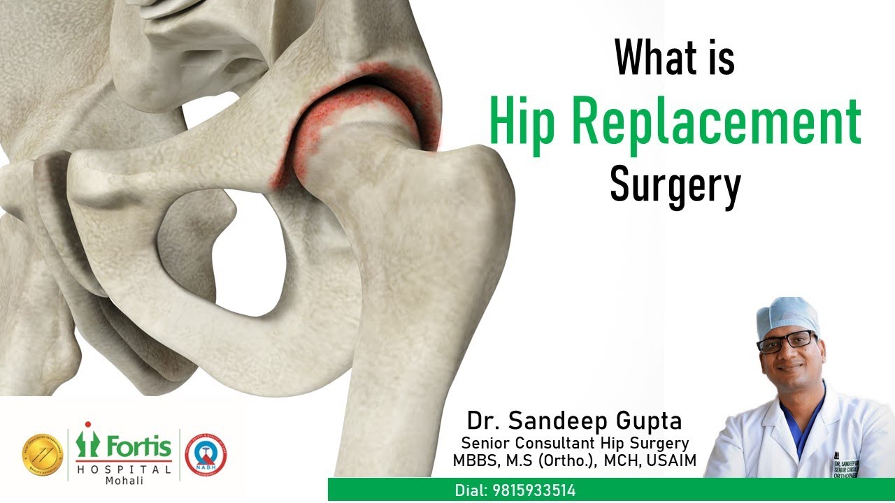 What is Hip replacement | Dr Sandeep Gupta | Best Hip Surgeon ...
