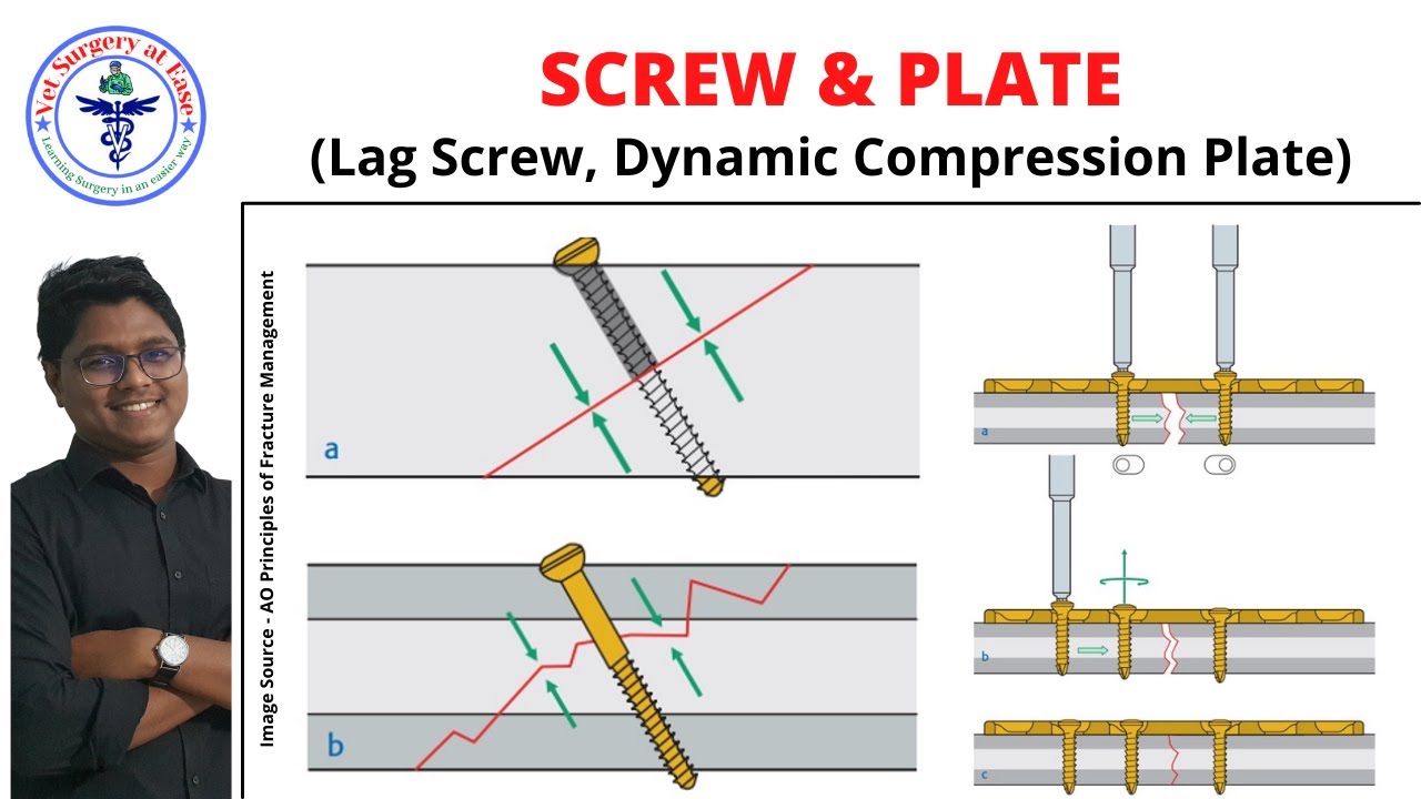 Screw & Plate | Lecture 09 | Orthopedics - YouTube