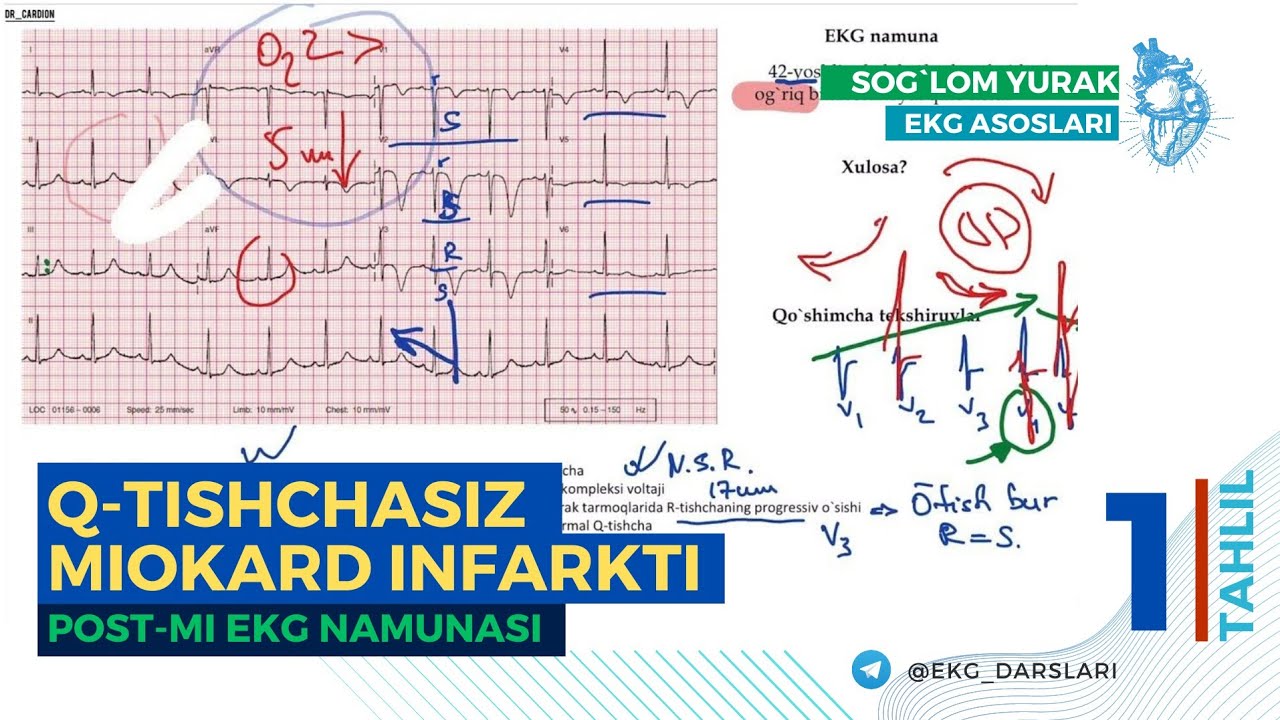 = EKG Tahlili-01 = Q-Tishchasiz Miokard Infarkti = Post-MI EKG Namunasi ...