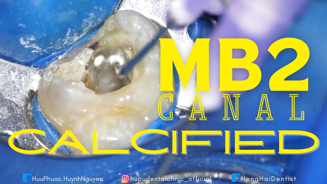 CALCIFIED MB2 CANAL | ỐNG TỦY MB2 CANXI HÓA | OFFICIAL VIDEO | BS Hữu Phước & BS Hồng Hải - YouTube