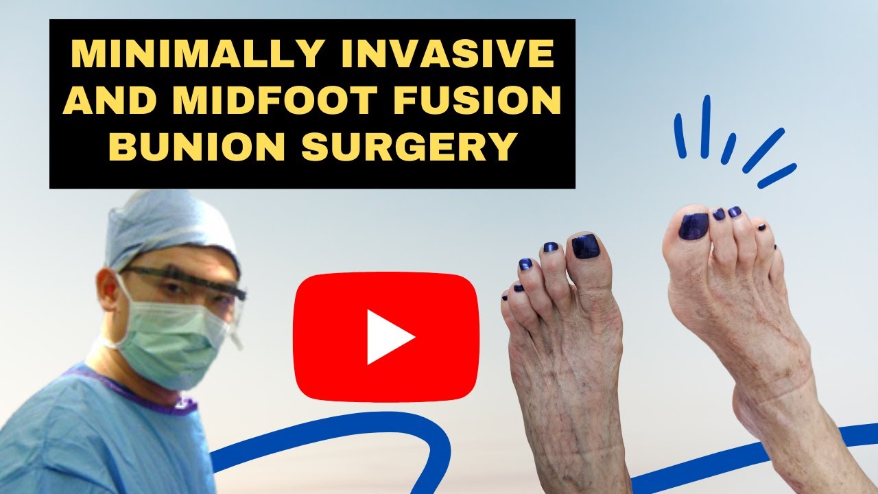 Minimally Invasive and Midfoot Fusion Bunion Surgery: X-Ray Review ...
