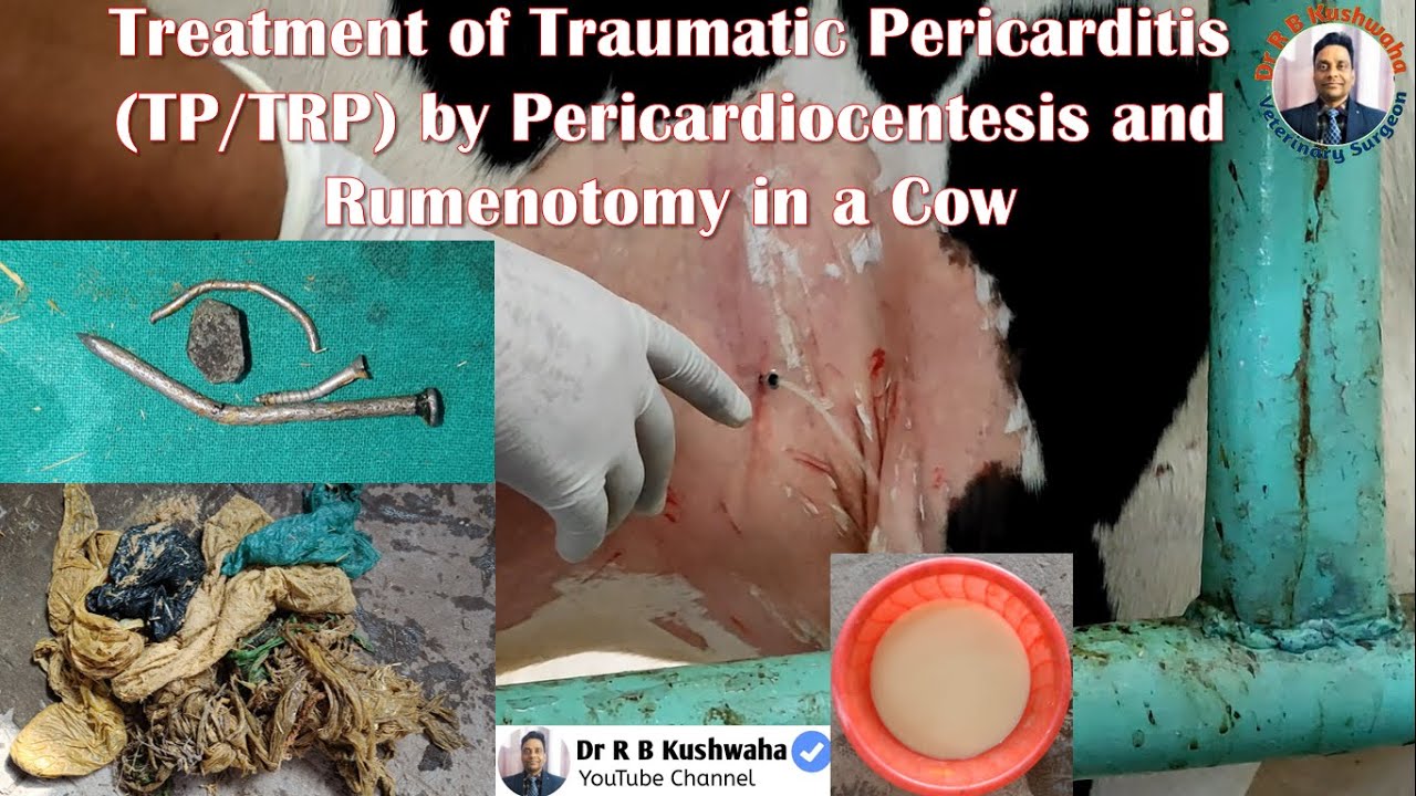 TRP/Traumatic pericarditis/pericardiocentesis/removal of nails and ...