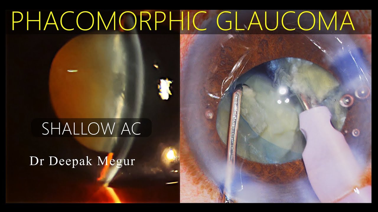 Phacomorphic Glaucoma with a very Shallow anterior Chamber ...