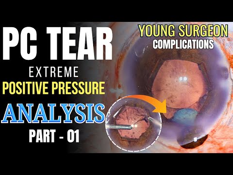 Extreme Positive Pressure - PC tear -Analysing the cause and management (Part - 01) Dr. Deepak Megur