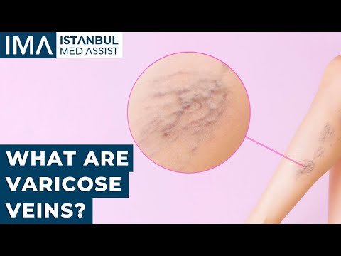 What are Varicose Veins? - Istanbul Medical Assistance
