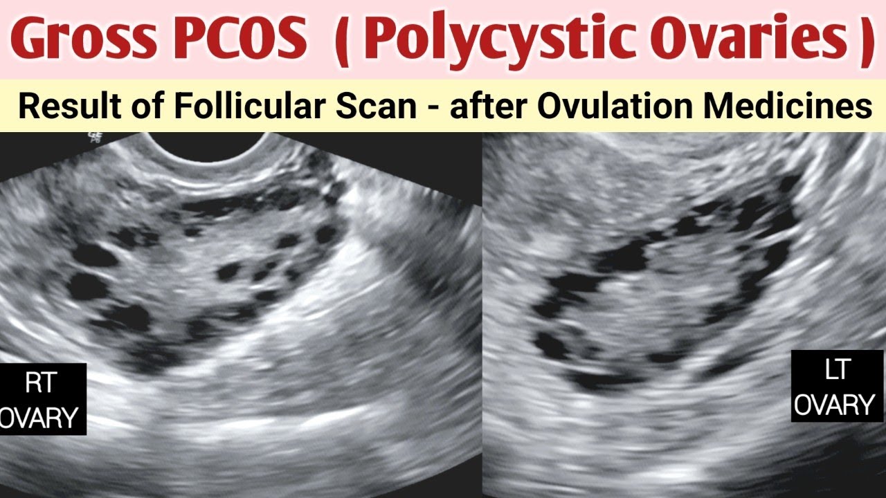 Polycystic Ovaries - Gross Grade 3 | PCOS | Ultrasound after Ovulation ...