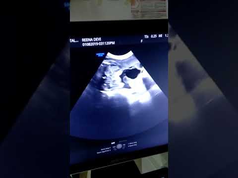 Placenta Subamniotic cyst /subamniotic hemorrhage - YouTube