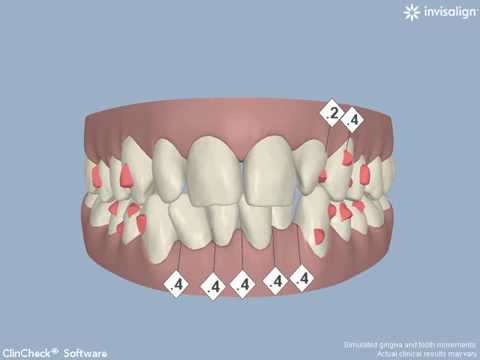 Invisalign - ClinCheck Simulation - Front (FINAL Treatment Plan) - YouTube