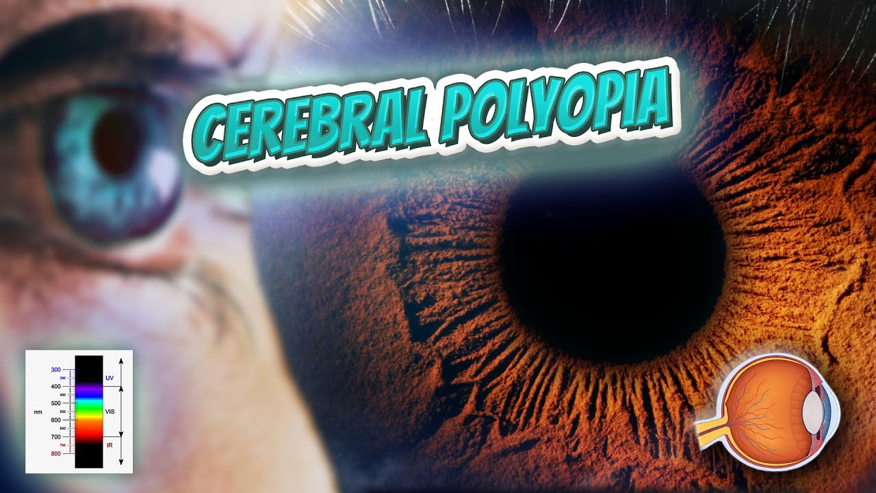 Cerebral polyopia - Your EYEBALLS - EYNTK 👁️💉😳💊🔊💯 - YouTube