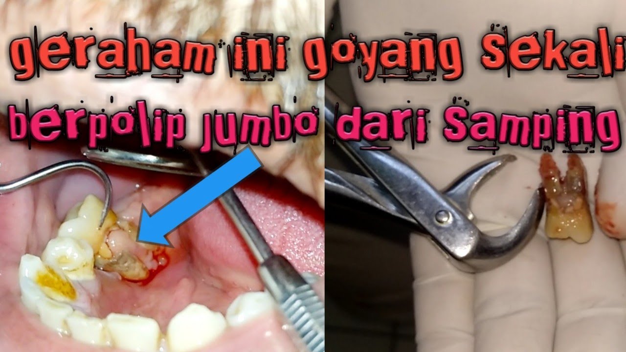 Cabut geraham bawah yang sudah goyang sekali dan ditumbuhi polip - YouTube