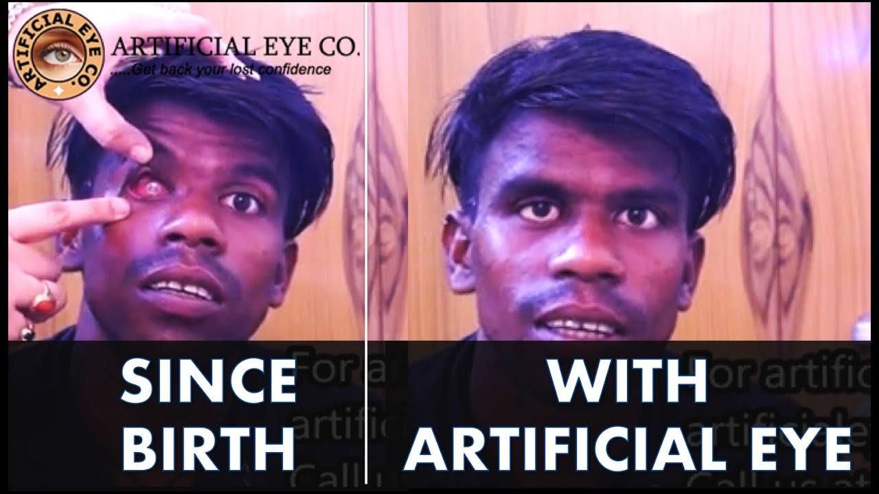 Artificial eye prosthesis for patient with defective eye since birth ...