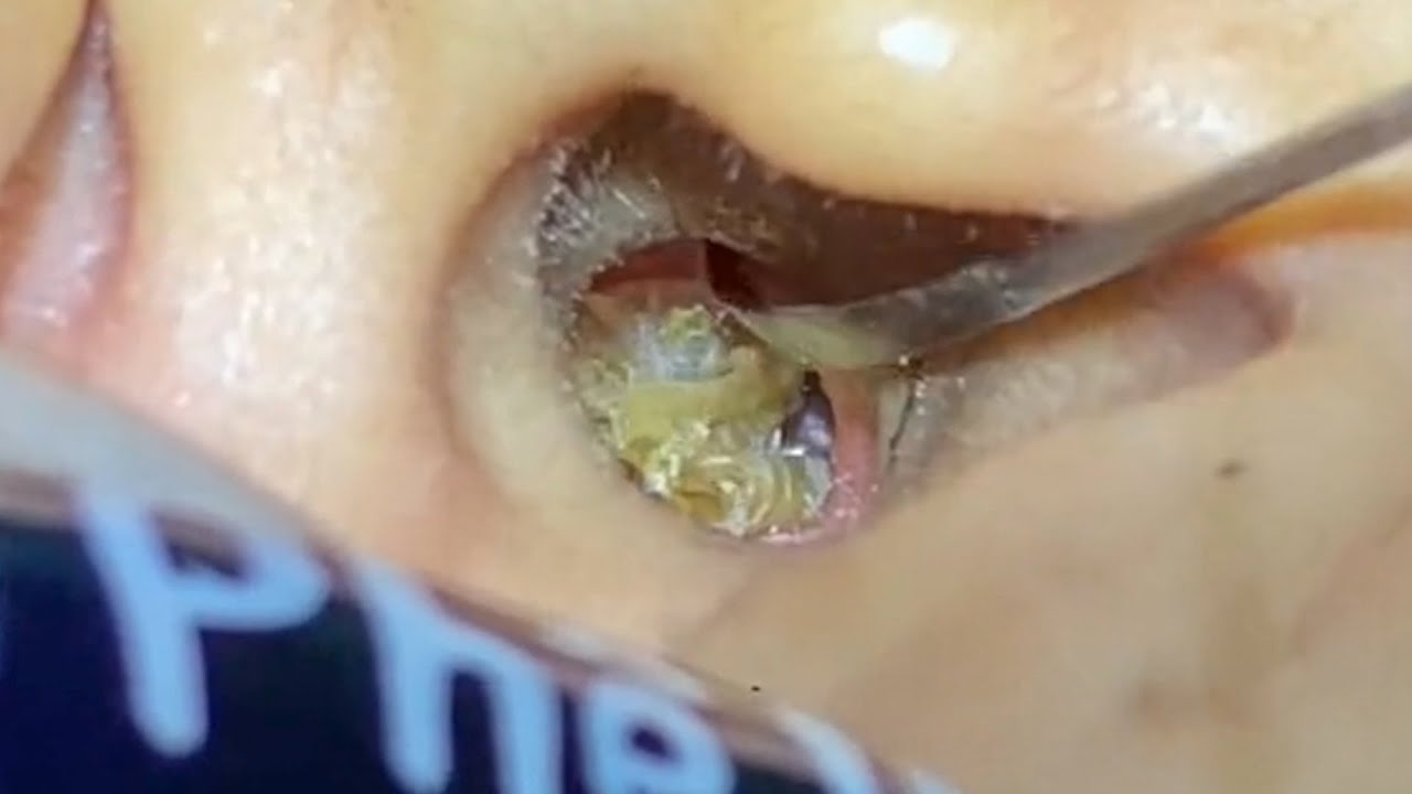 ASMR Ear Cleaning – The Surprising Health Benefits of Proper Ear Care ...