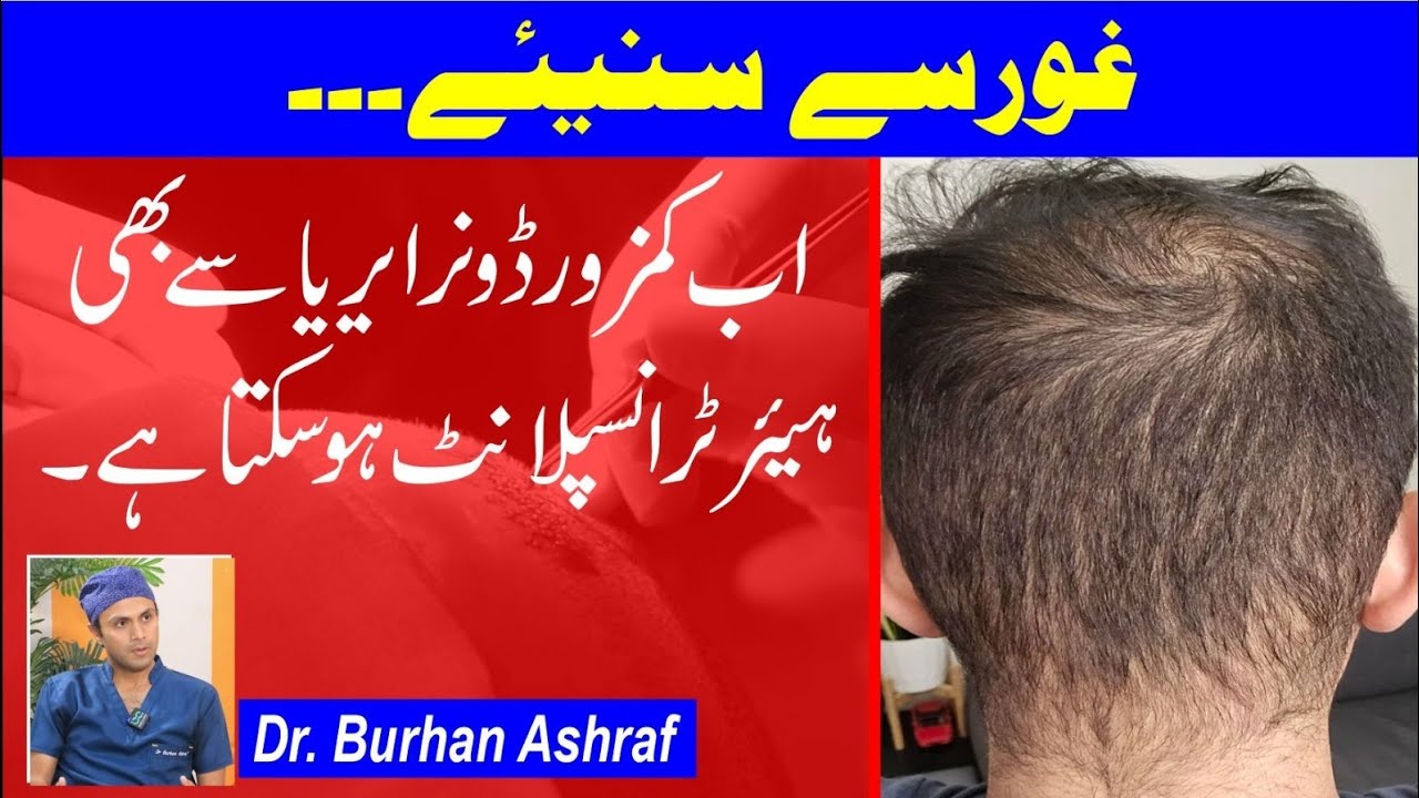 Can You Get a Hair Transplant with a Weak Donor Area? - YouTube