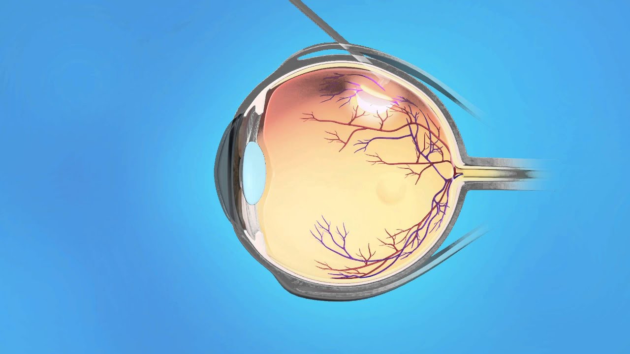 Retinal Tear Cryopexy - YouTube