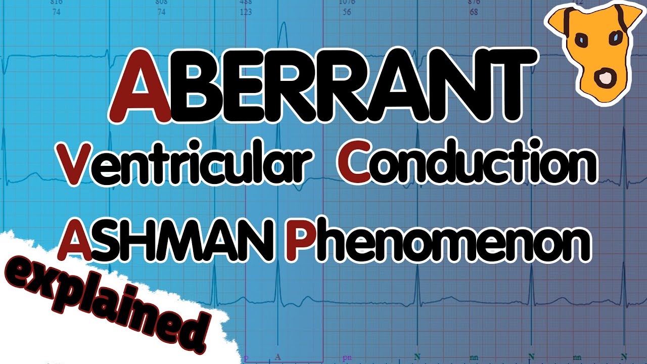 ABERRANT VENTRICULAR CONDUCTION. Ashman Phenomenon. Explained. - YouTube