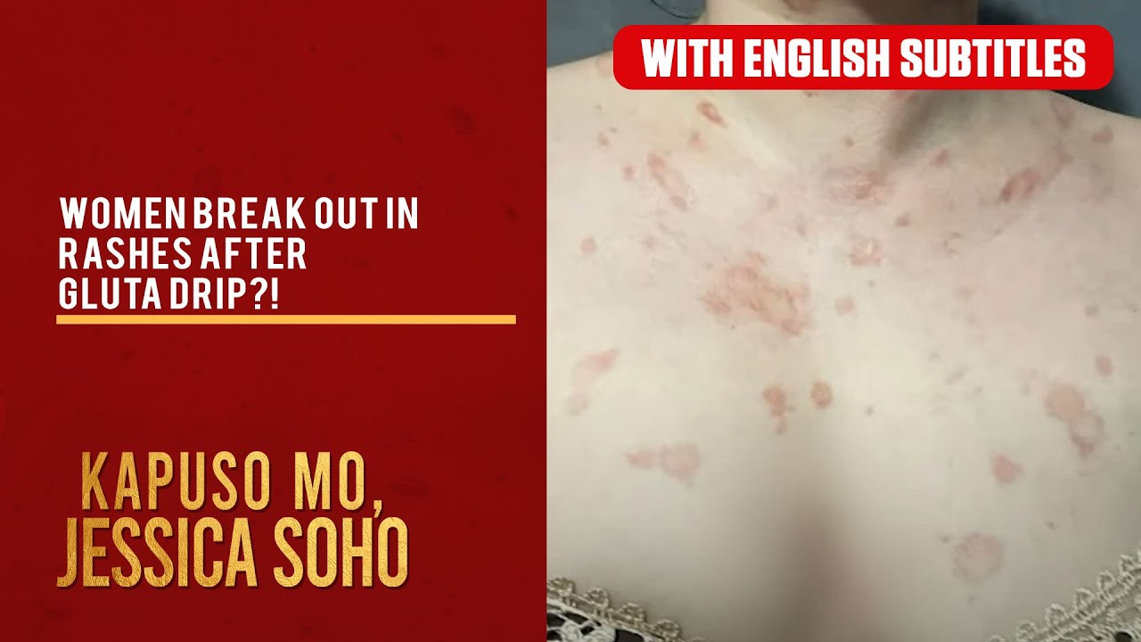 Women break out in rashes after gluta drip?! (with English subs ...