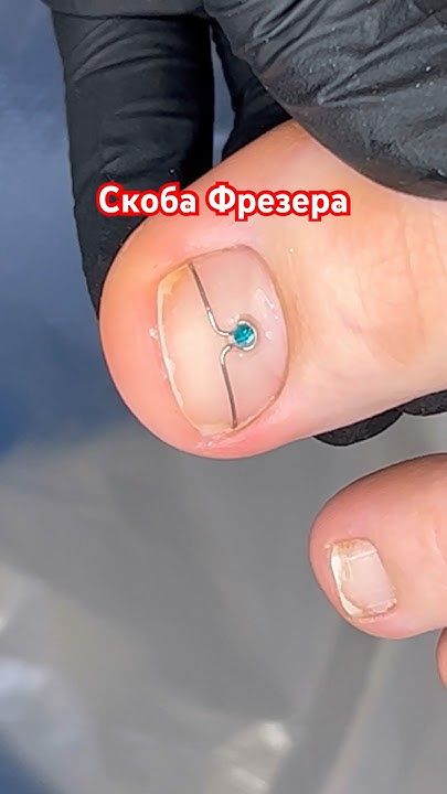 Скоба Фрезера / как сделать скобу фрезера / скобы для ногтей - YouTube