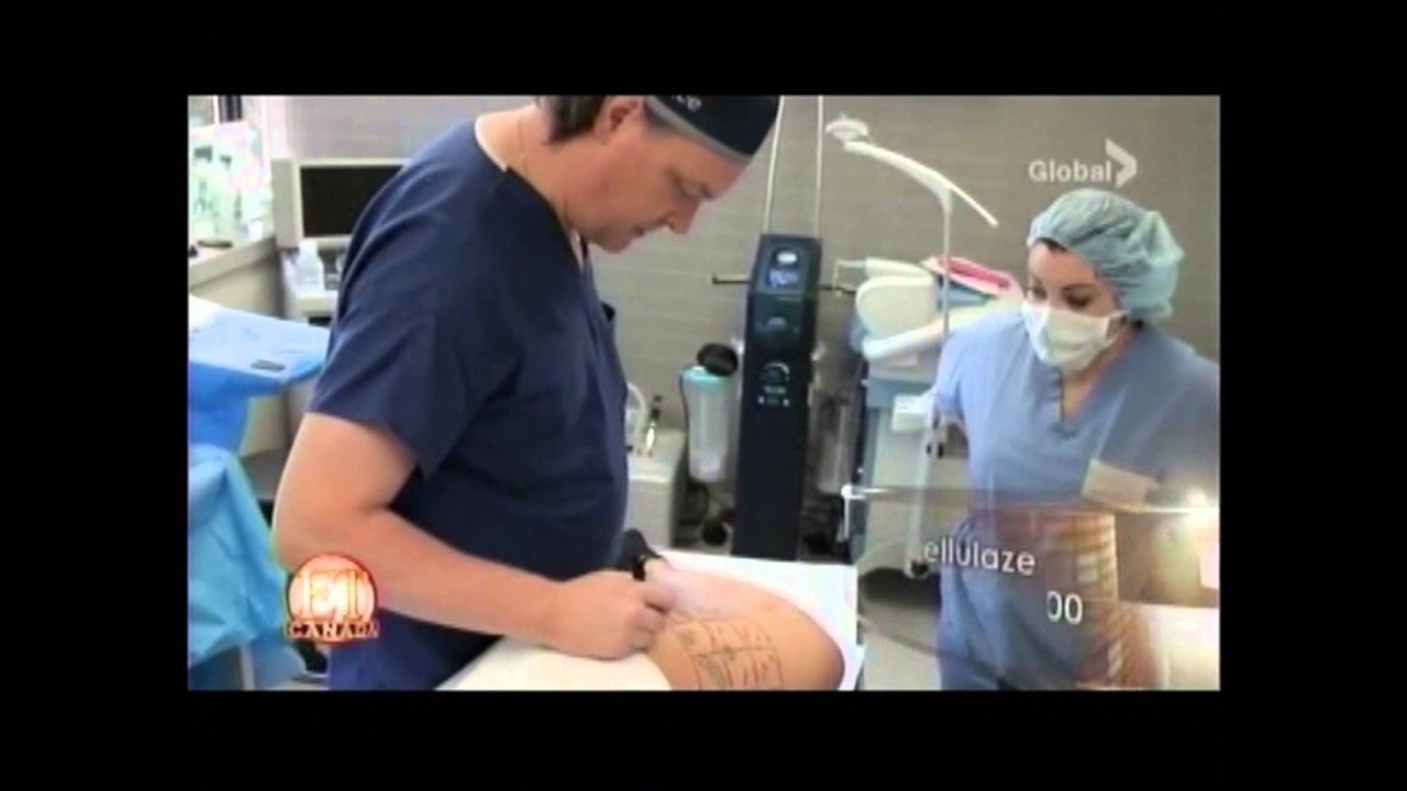 Entertainment Tonight Canada - Rice Cosmetic Surgery - Cellulaze - YouTube