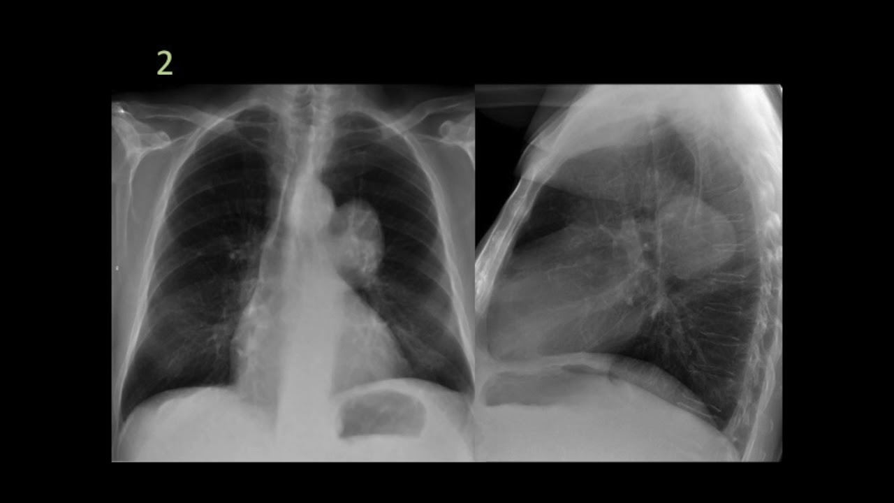 TMT: XRAY CHEST: HILUM OVERLAY SIGN - YouTube