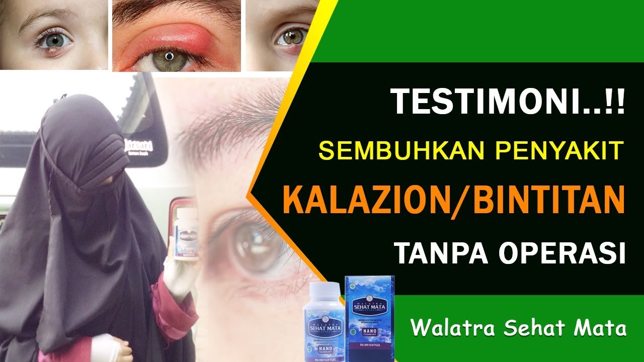 Testimoni..!! Sembuhkan penyakit Kalazion/Bintitan Tanpa Operasi dengan ...