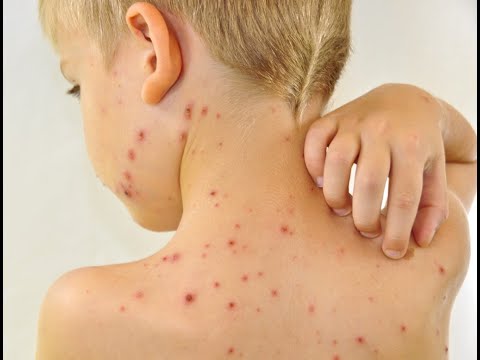 ارتفاع الحرارة والطفح الجلدي - صحة طفلك - د.نضال سعيفال - أخصائي طب الأطفال