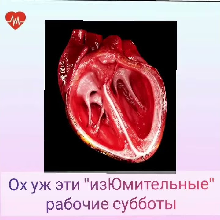 Очаговые изменения миокарда ЛЖ ИКД в правых отделах сердца Youtube