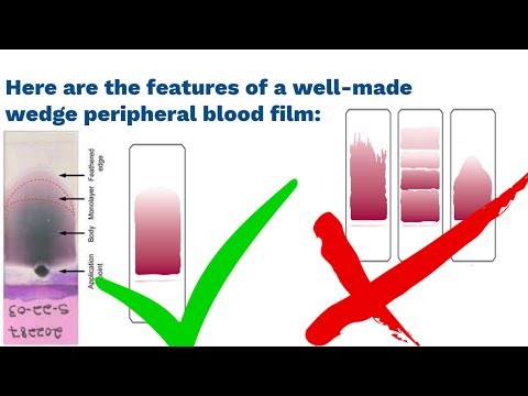 Mastering Blood Film Preparation and Examination - YouTube