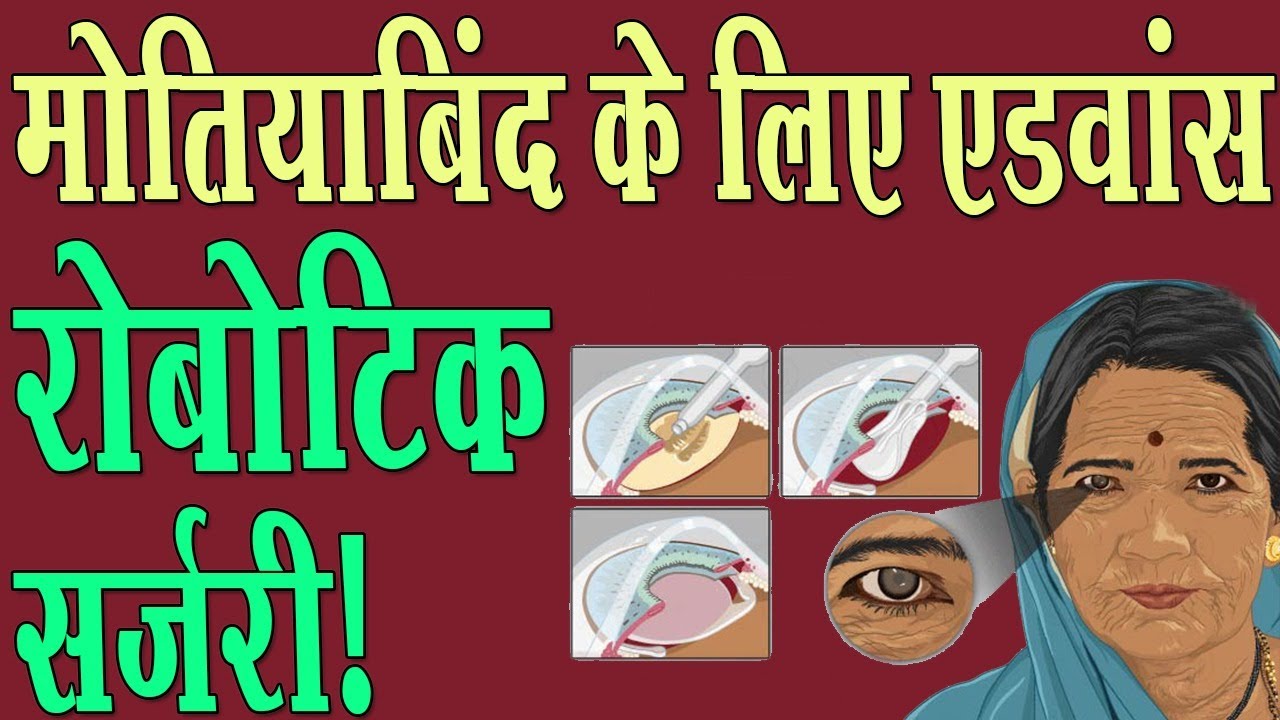 मोतियाबिंद के लिए एडवांस रोबोटिक सर्जरी ! // Robotic Surgery for ...