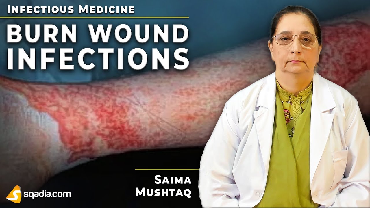 Burn-Wound Infections | Introduction - YouTube