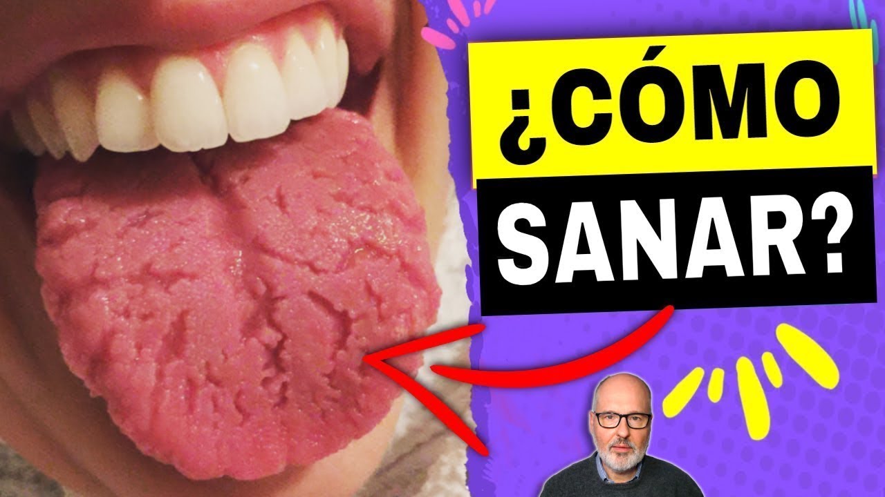 CÓMO SANAR LA LENGUA AGRIETADA (REMEDIOS NATURALES) - YouTube