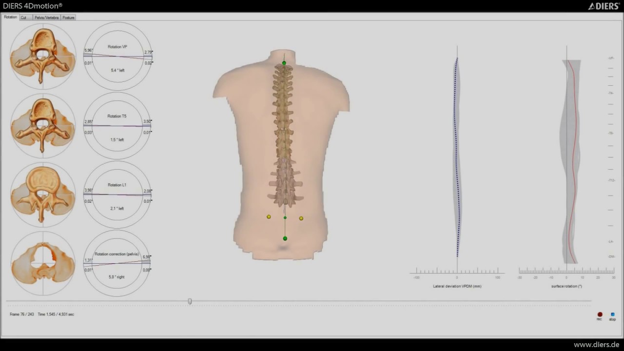 DIERS 4Dmotion® - Dynamic Spine & Posture Analysis - YouTube