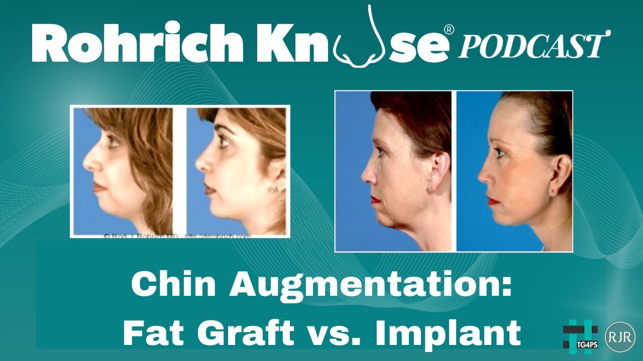 Chin Augmentation- Role of Fat Grafting vs. Silicone Chin Implants ...