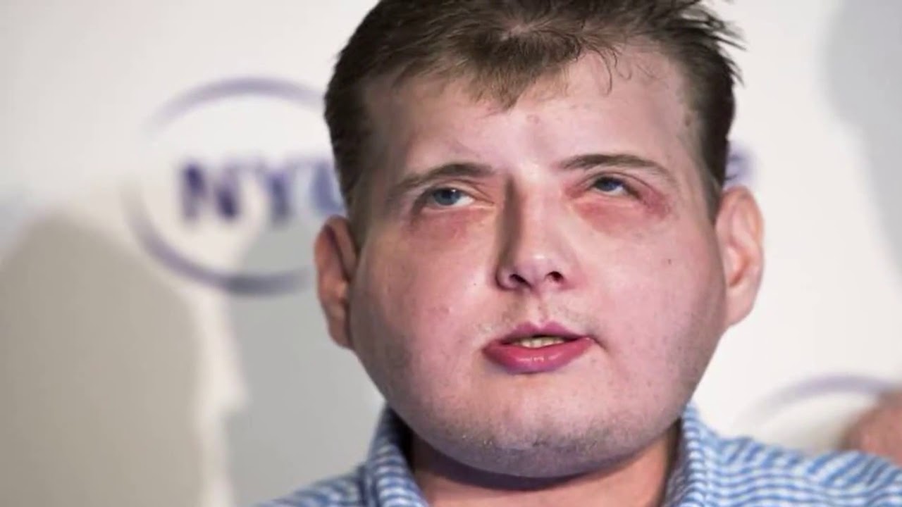 Facial Transplant Patients on Life After Surgery Now I Can Feel Kisses ...
