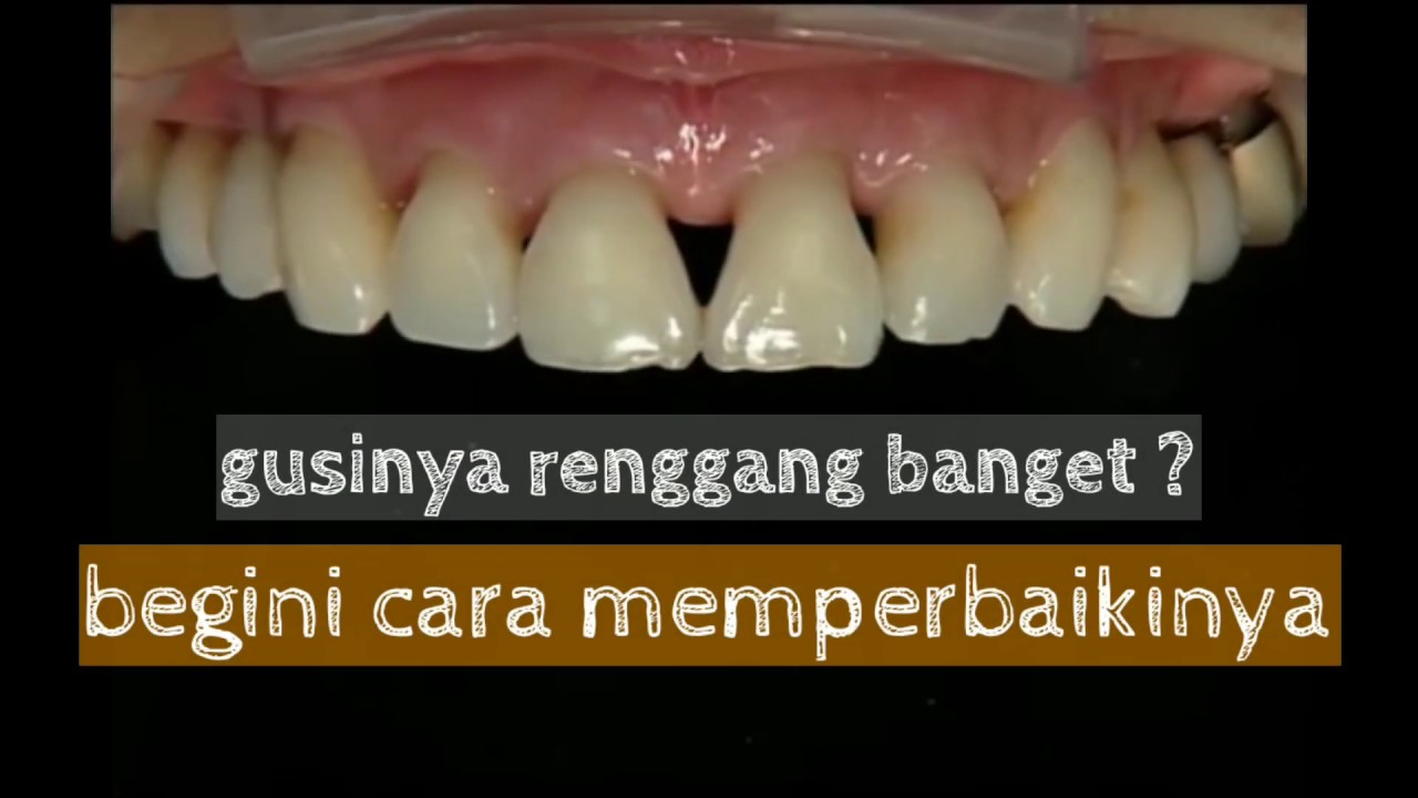 Gusi Turun? Menyebabkan Gigi Terlihat Renggang! Solusinya Begini Lho ...