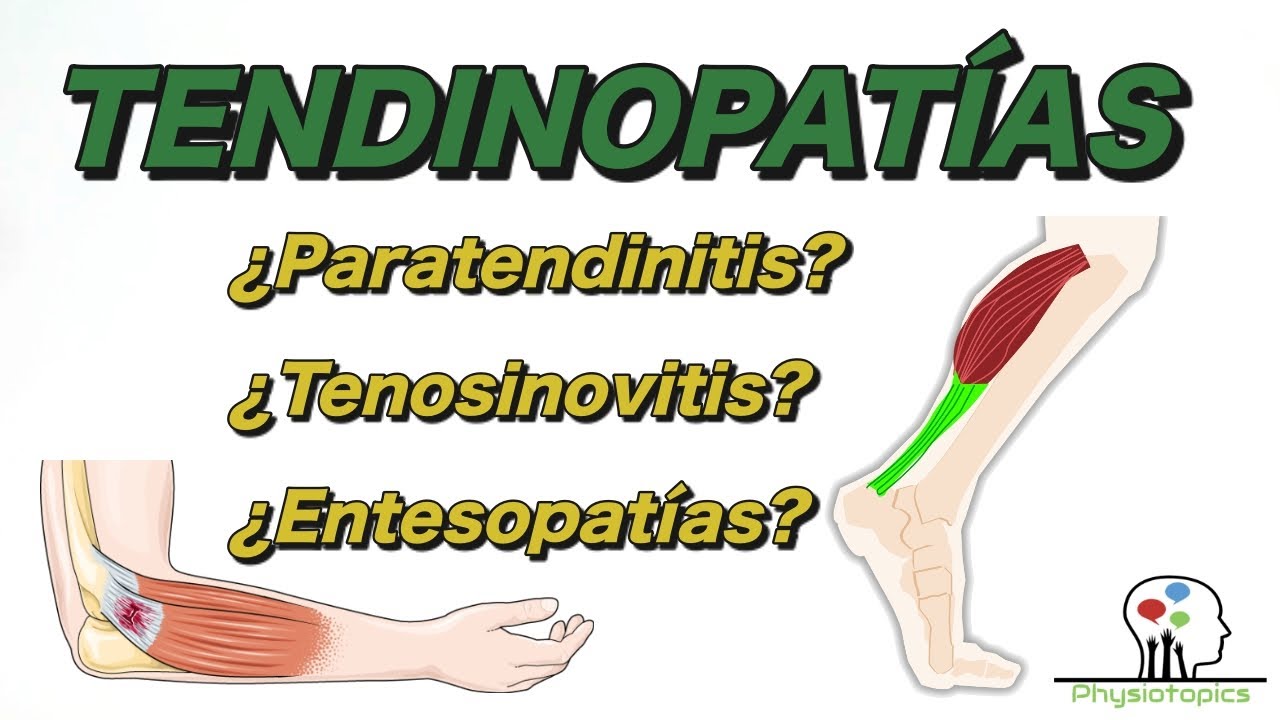 ¿Tendinitis o tendinosis? Causas y tratamiento de las tendinopatías ...